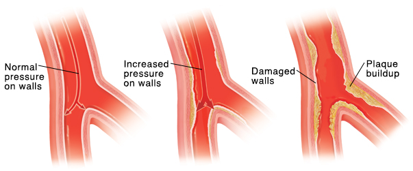 what-is-high-blood-pressure-sterling-care-in-home-care-westchester
