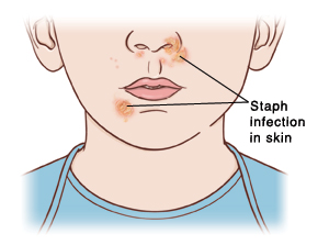 Staph Infection Symptoms