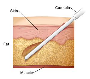 Liposuction - Sterling Care - In-Home Care Westchester NY - In-Home ...